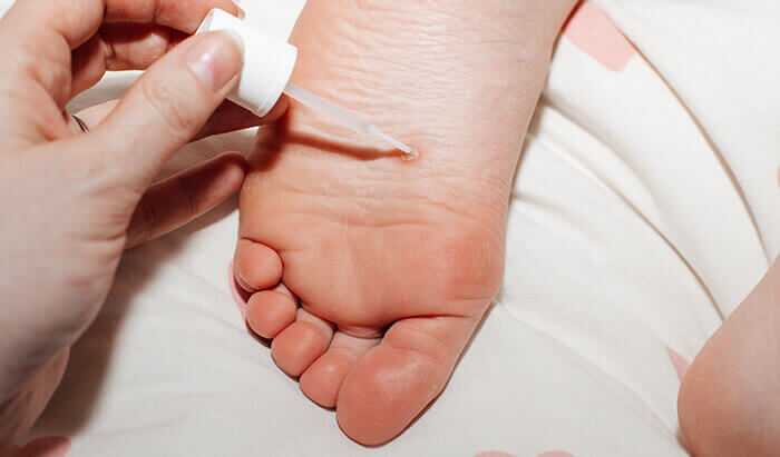 Comment traiter une verrue ? Conseils et traitements